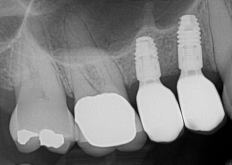Understanding Sinus Lift in Dental Implant Surgery